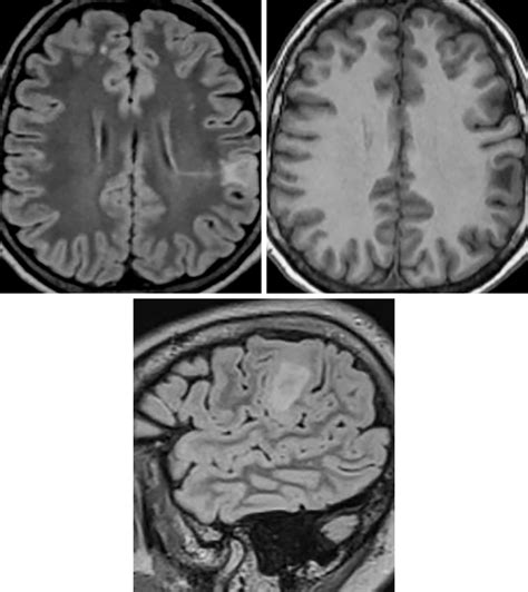 Cortical Dysplasia The Neurosurgical Atlas