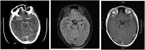 Naegleria Fowleri Brain