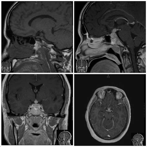 Pdf Primary Granulomatous Hypophysitis Presenting With Secondary Hypothyroidism