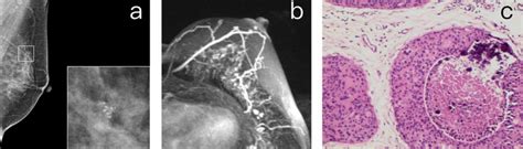 A A 55 Year Old Premenopausal Female Who Underwent Screening