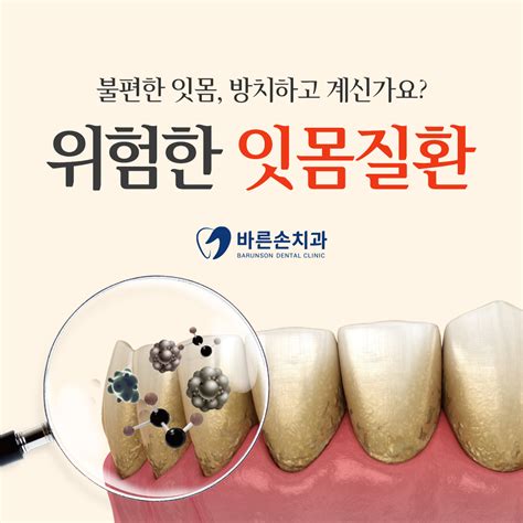 의정부 바른손치과신곡동치과신곡동임플란트신곡동라미네이트의정부치과 안녕하세요 바른손치과 입니다 스케일링 파헤치기 스케일링은 단순히 치석을 제거하는 것을