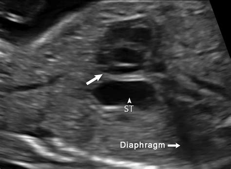 Multimodality Evaluation Of Fetal Congenital Diaphragmatic Hernia And