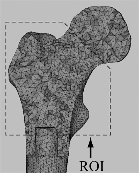 A Detail Of The Proximal Femur Finite Element Model Sectioned Along The