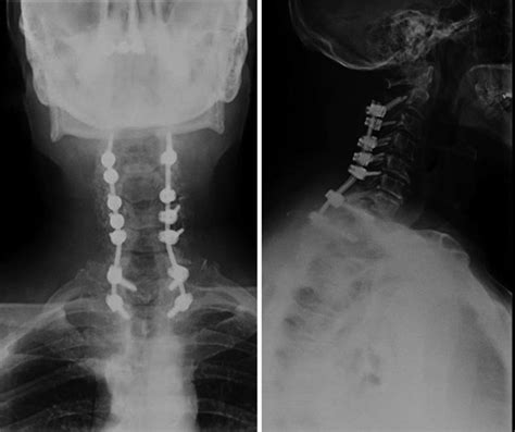 Crossing The Cervicothoracic Junction An Evaluation Of Radiographic