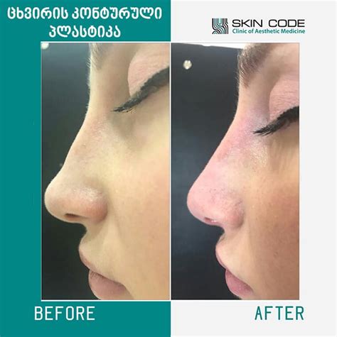 რა არის ფილერი და რამდენად უსაფრთხოა მისი გამოყენება ინტერვიუ „სკინ კოდის“ ექიმ კოსმეტოლოგთან