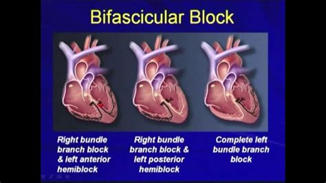 5 2 E Bi Tri Fasicular Block Bradyarrhythmias [hong Kong University] Youtube