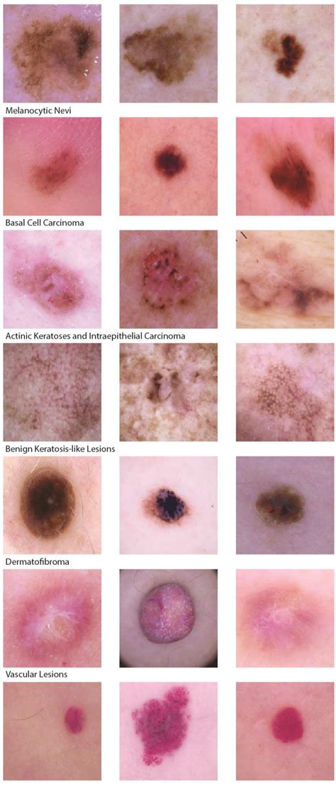 논문 리뷰 Enhancing Skin Lesion Diagnosis with Ensemble Learning