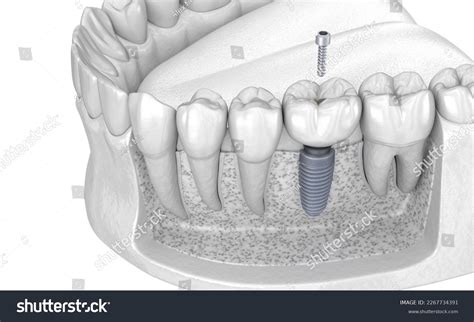 Dental Crown Installation Over Implant Abutment Stock Illustration