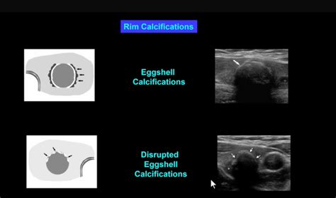 Thyroid Nodules With Eggshell Calcifications Rodrigo Arrangoiz Ms Md