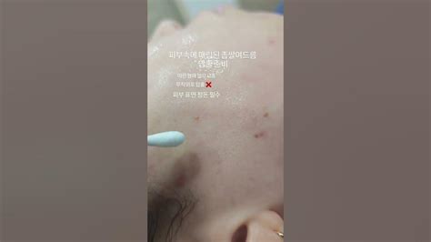 거제피부관리 피부관리 이은희에스테틱 슈퍼젝션 통영에스테틱 에스테틱 통영여드름 여드름 부산여드름 여드름교육 150만원 ️ 파메스테틱 입점 후 50만원