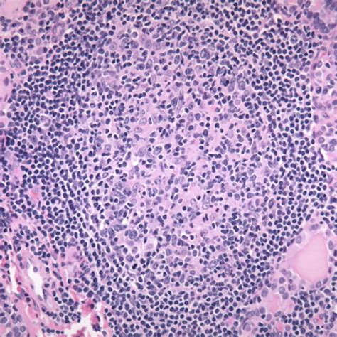 Chronic Lymphocytic Thyroiditis Note Lymphoplasmacytic Inflammation Download Scientific