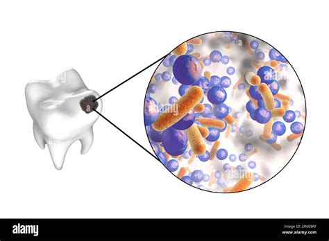 Dental Caries Occur When Bacteria In The Mouth Feed On At Juan Mann Blog