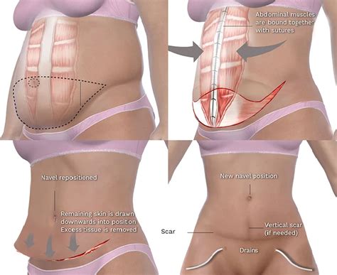 Appendix Removal Appendectomy Wikipedia