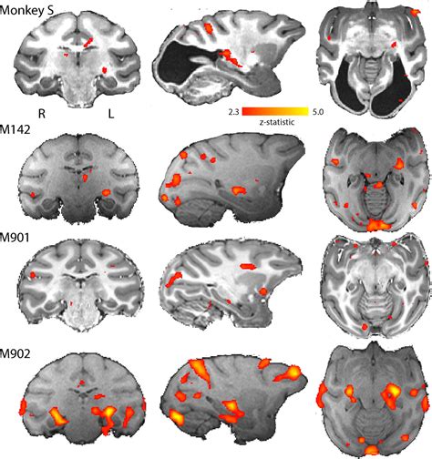 Extrastriate Visual Cortex Daily Anatomy Magnetic Resonance Image