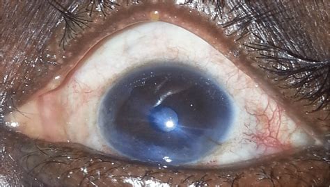 Anterior Synechiae Dog