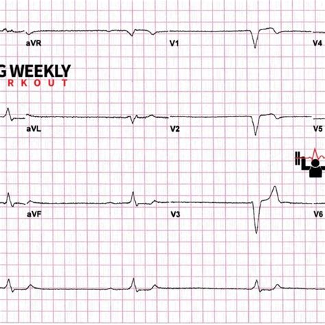 Digoxin Toxicity Ecg Weekly