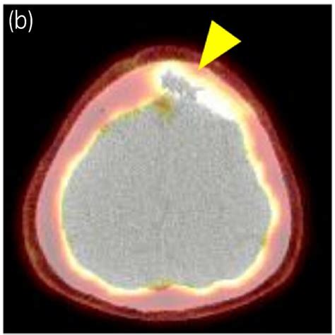 Imaging Evaluation At Tumor Marker Re‐elevation Showed Exacerbation Of Download Scientific