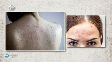 რატომ ჩნდება და როგორ მოვირჩინოთ აკნე Youtube