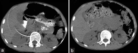 Identification Of A Unique Cause Of Ring Artifact Seen In Computed Tomography Trans Axial Images