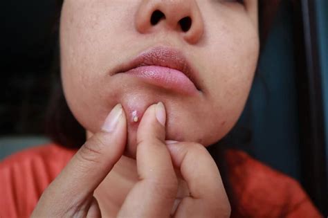 How To Quickly And Easily Remove Blackheads From Your Chin At Home