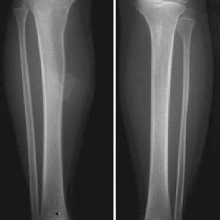 An Anteroposterior View Of A Plain Film Radiograph Demon Strates Bony