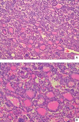 5 Classic Lab Findings Flashcards Quizlet