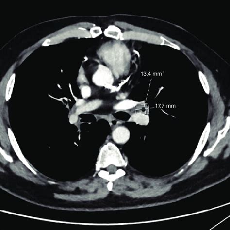 Computed Tomography Chest From May 2016 Showing 18 Mm Nodular Lesion In Download Scientific