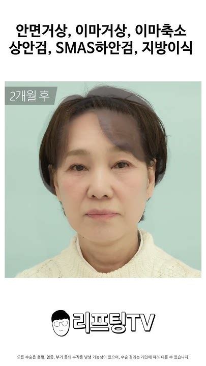 10살 어려졌나요 동안성형 안티에이징 성형수술전후 Youtube