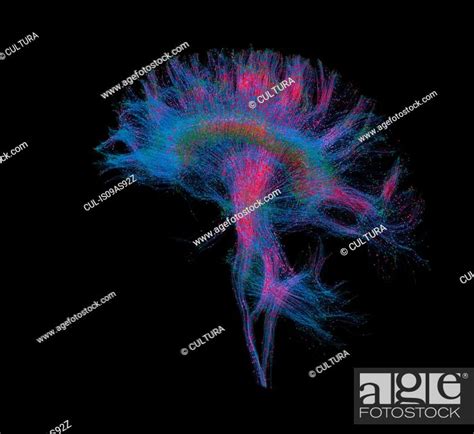 Diffusion MRI Also Referred To As Diffusion Tensor Imaging Or DTI Of The Human Brain Stock