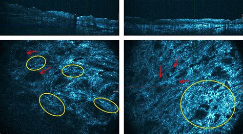 High Definition Optical Coherence Tomography Examination Revealed A
