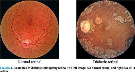 Figure 1 From Vision Transformer Model For Predicting The Severity Of Diabetic Retinopathy In