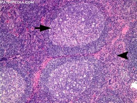 Lymphatic System Flashcards Quizlet
