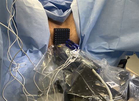 Uva Health Employs Innovative Techniques For Prostate Cancer