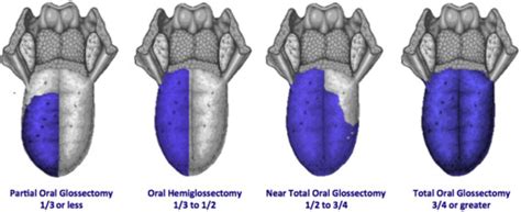 Surgical Management Of Oral Cancer Dental Clinics