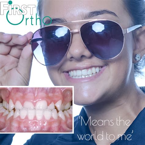 Underbite Correction Without Surgery First Ortho