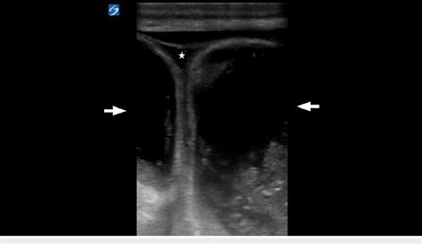 Fluid Filled Loops Of Bowel Arrow With Interloop Free Fluid Star