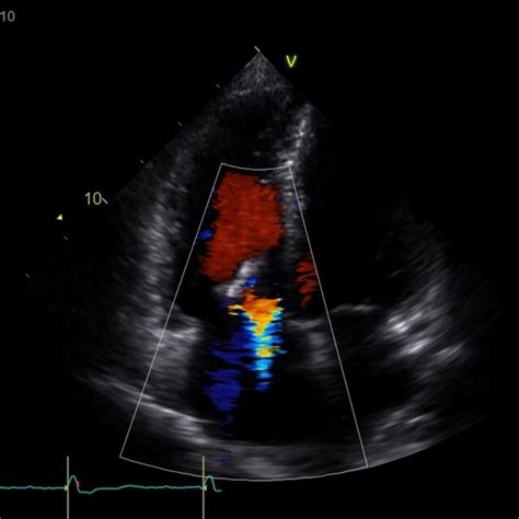 Caption Example Of Moderate To Severe Ftr In A Hfref Patient With A Download Scientific