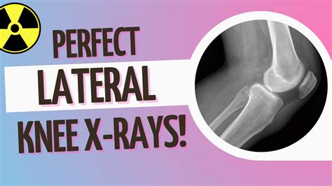 Lateral Knee X Rays