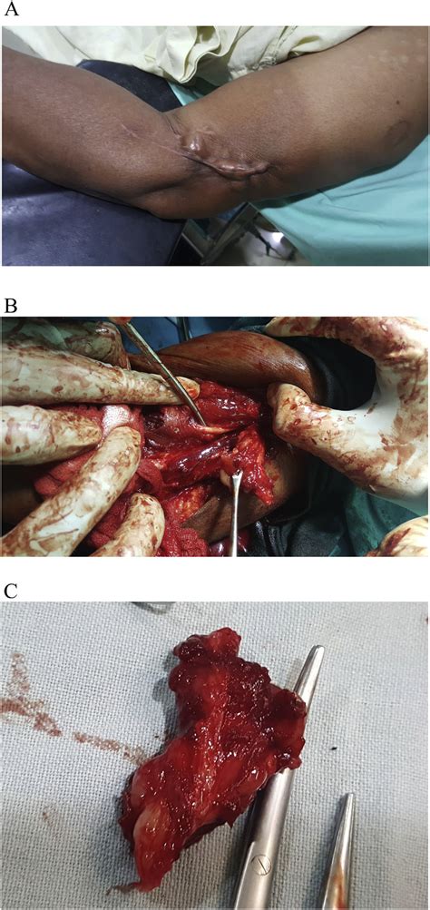 A Clinical Picture Of Multiple Recurrent Nodular Swellings At Scar