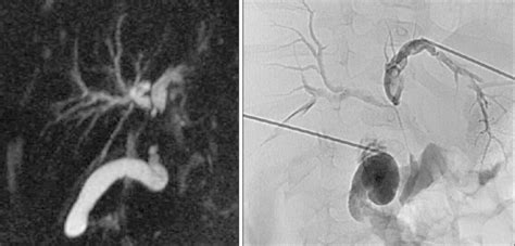 Initial Magnetic Resonance Cholangiopancreatography And Cholangiogram
