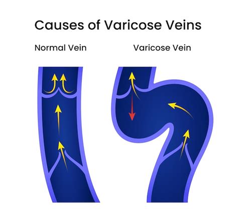 Las Causas De Las Venas Varicosas Vector Premium