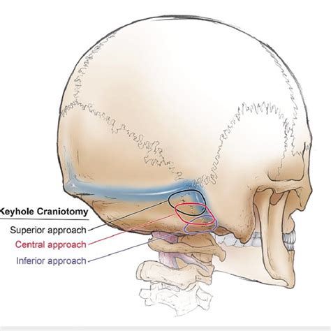 Pdf Immersive Surgical Anatomy Of The Retrosigmoid Approach