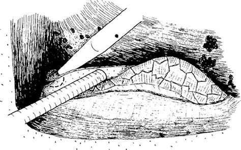 Basic Mastoidectomy Techniques Ento Key Basic Mastoidectomy Techniques Ento Key