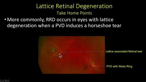 Lattice Degeneration