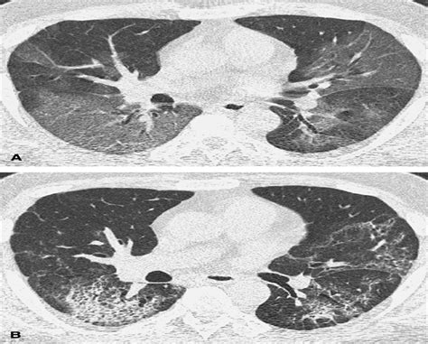 Imaging Of Unusual Diffuse Lung Diseases Current Opinion In Pulmonary Medicine