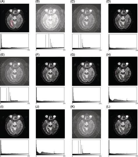 Brain Mri Image Histogram Equalization Result A Original Image B Download Scientific