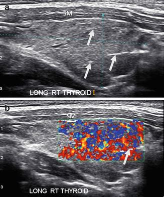 Diffuse Thyroid Disease DTD And Thyroiditis Radiology Key