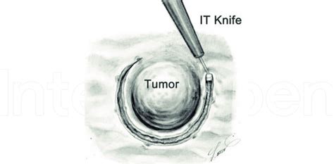 Endoscopic Submucosal Resection Around The Tumor And Artificial