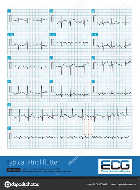 Male Years Old Clinically Diagnosed Copd Paroxysmal Atrial Flutter Atrial — 스톡 사진 © Asia11m