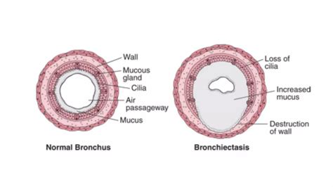Bronquiectasias Pdf Lung And Respiratory Health Diseases And